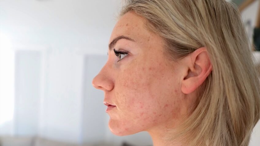 Does Retinol Cause Cancer? Unveiling the Truth - Fischer Institute