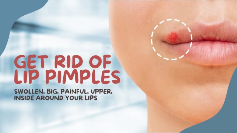 Get Rid of Lip Pimples Swollen, Big, Painful, Upper, Inside Around Your ...