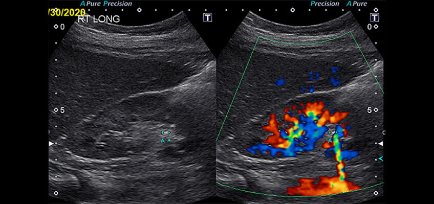 Do I Have Kidney Stones or a UTI? How To Tell the Difference - Fischer ...