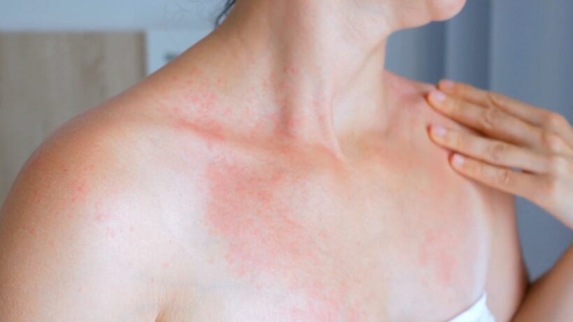 Skin Health and Lemons: Natural Remedies for a Glowing Complexion ...